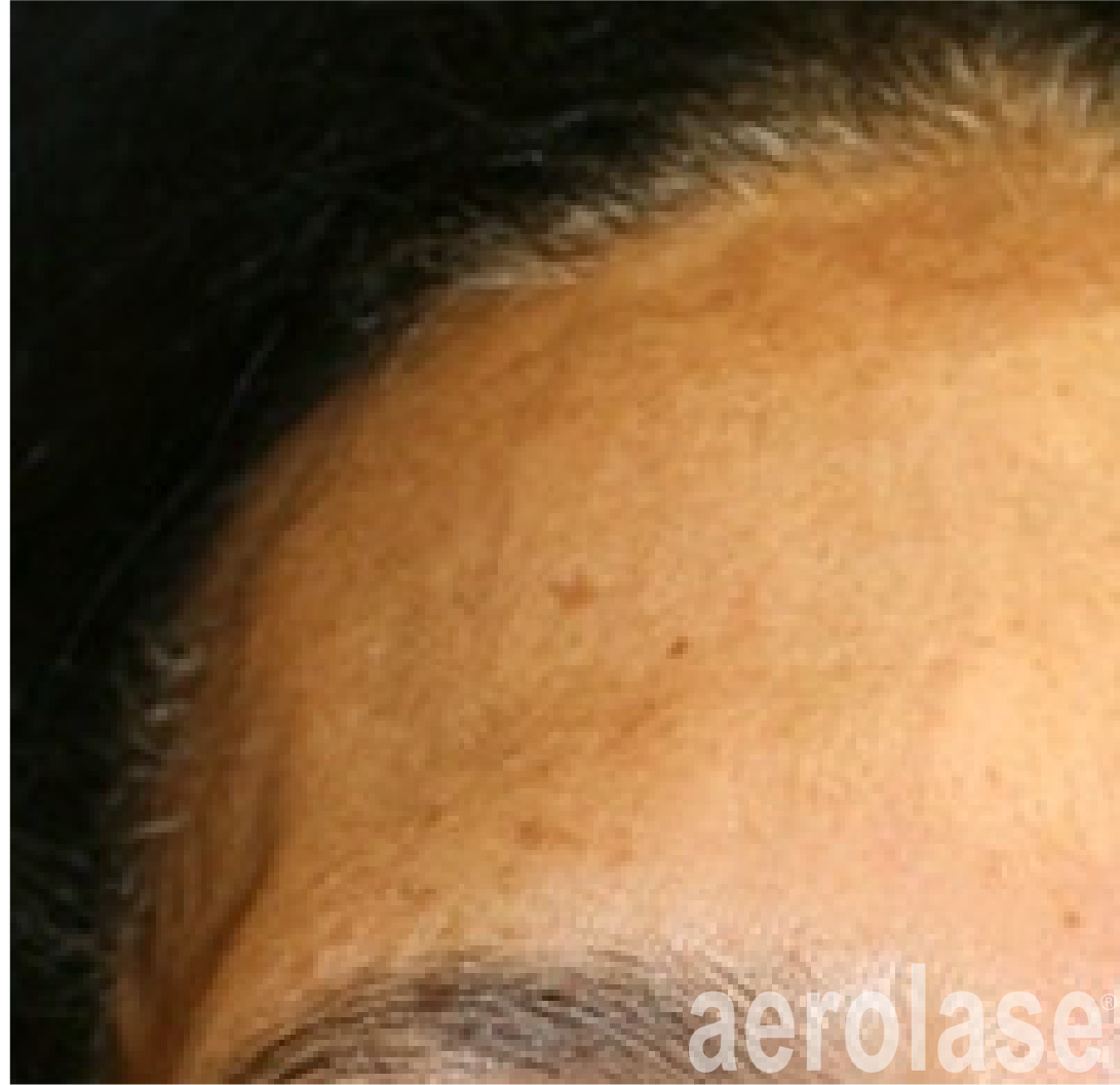 Laser Treatments - Bella Laser and Spa