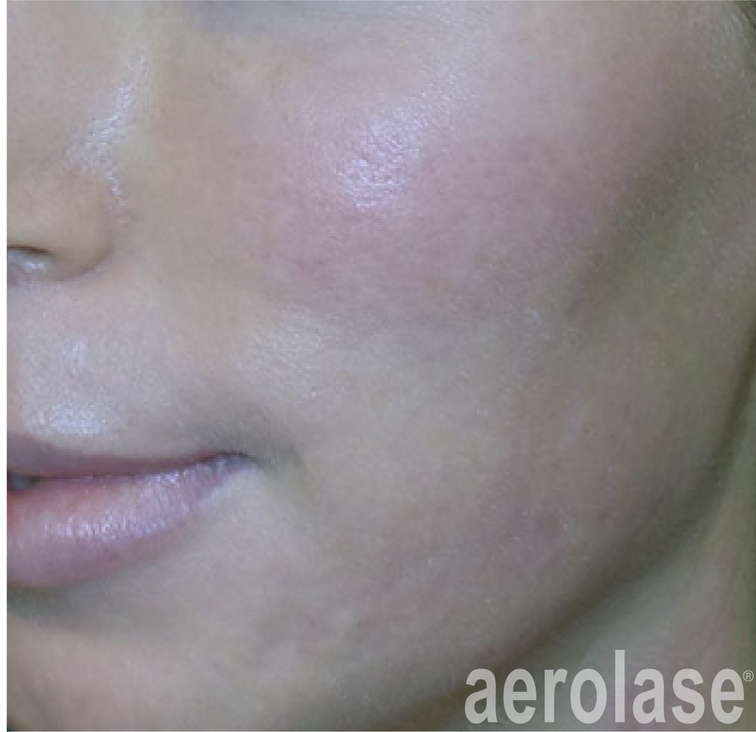Laser Treatments - Bella Laser and Spa