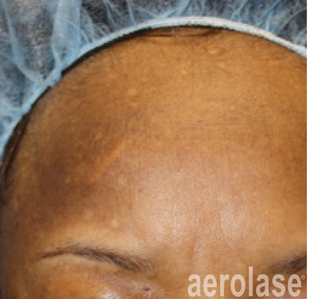 Laser Treatments - Bella Laser and Spa