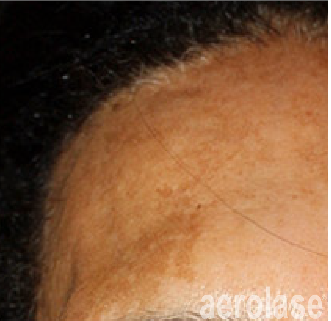 Laser Treatments - Bella Laser and Spa